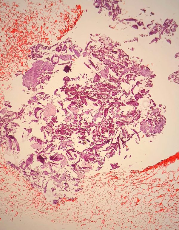 K. Squamoso infiltrante osso teca cranica (scraping) – Cytomatrix