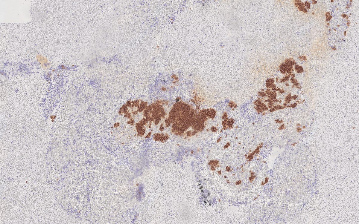 K. Squamoso infiltrante osso teca cranica (scraping) – Cytomatrix